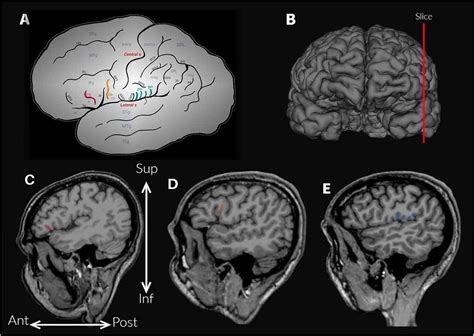 Operculum Brain Of The L