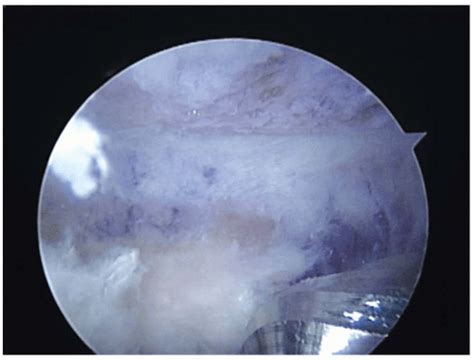 Arthroscopic Subacromial Decompression Musculoskeletal Key