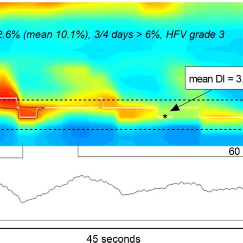 Technique For Measuring Esophagogastric Junction Distensibility Index