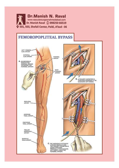Femoral Popliteal Bypass Vascular Surgeon Ahmedabad
