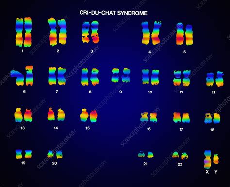 Cri Du Chat Syndrome Stock Image C0220573 Science Photo Library