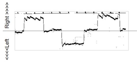 L4 Positionalpositioning Bppv Flashcards Quizlet
