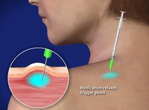 Trigger Point Injections Phoenix Car Accident