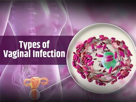Vaginal Infections Types