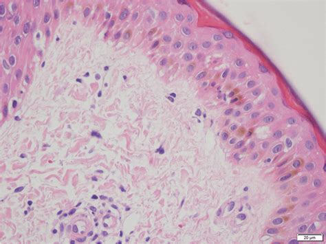 Punch Biopsy Of An Incipient Cutaneous Lesion There Is Focal Interface