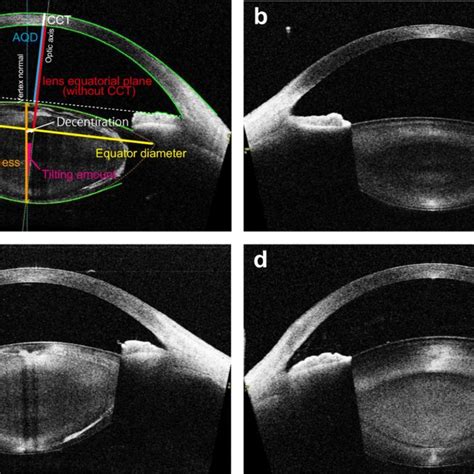 Comparison Of Anterior Segment And Lens Biometric Measurements In Patients With Cataract