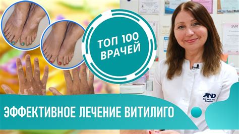 Лечение витилиго в домашних условиях народными средствами Как избавиться от витилиго Youtube