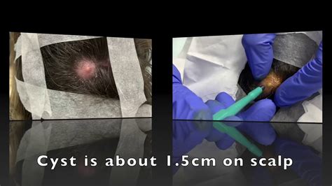 Removal Of Pilar Cyst No Stitches Youtube
