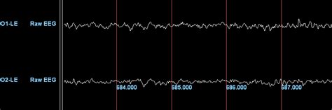 Eeg Muscle Artifact Last Session Download Scientific Diagram