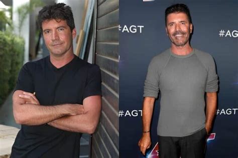 Simon Cowell Plastic Surgery Story Behind His Multiple Surgeries