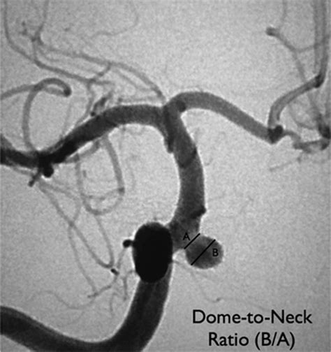 Are Aneurysms Treated With Balloon Assisted Coiling And Stent Assisted