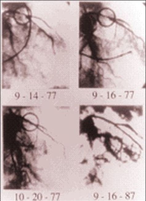 Angiograms Of Gruentzig First Ptca To A Proximal Lad Lesion Performed In 1977 The Encircled
