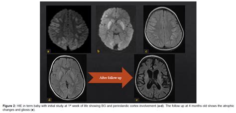 Journal Of Radiology Hypoxic Ischemic Encephalopathy MRI Findings And Patterns Review Revisited