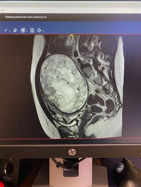 Before And After My Abdominal Hysterectomy 31 F For Big Fibroid This Was The Right Decision For