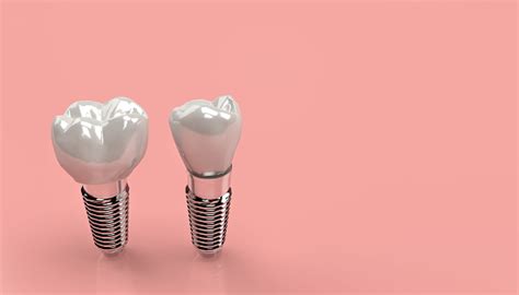 치아 또는 치과 임플란트 인간의 의치 클로즈업 3d 일러스트레이션 인공 크라운을 지원하기 위해 턱 뼈에 포함 된 치아 뿌리 복사 공간이 있는 배경에서 격리된 해부학