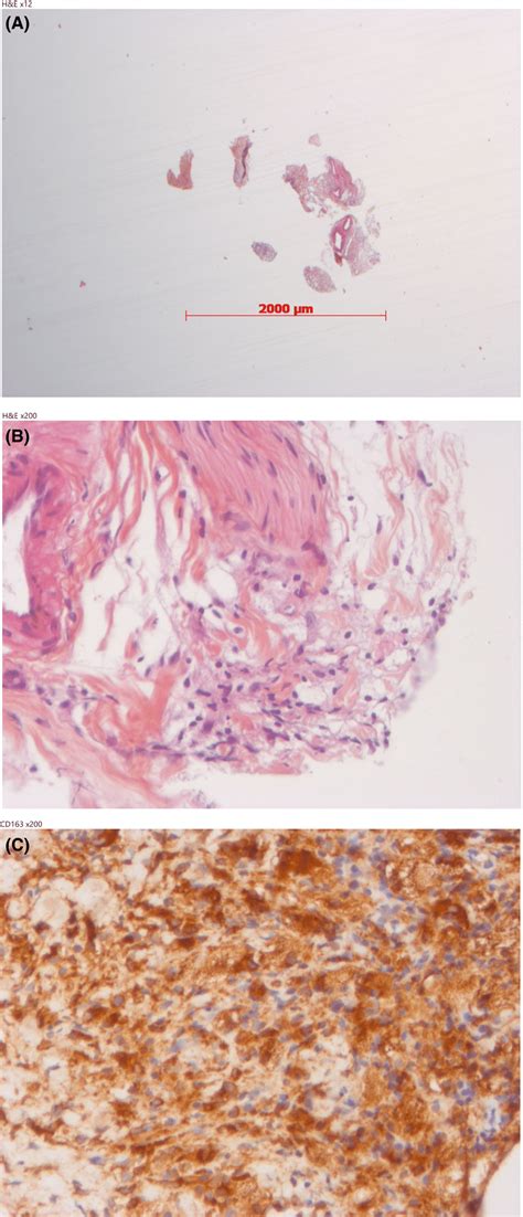 A B Histopathologys Renal Biopsy Showing Foamy Histiocytes With