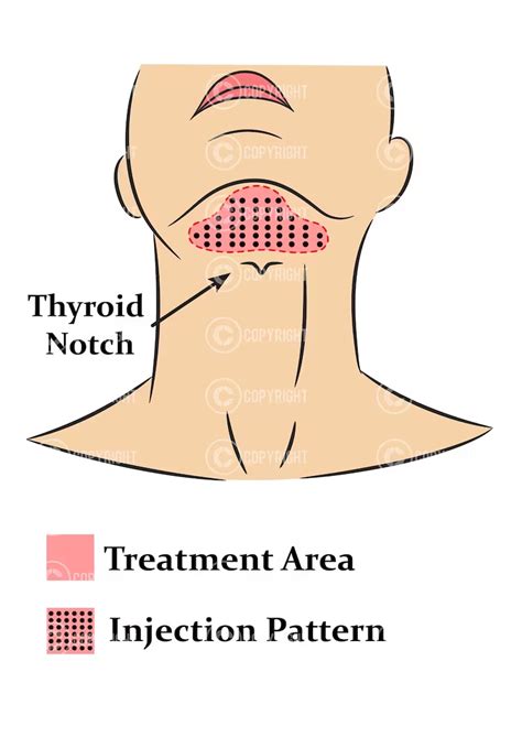 Fat Dissolving Injection Pattern Aqualyx Deso Lipolab Botox And Filler