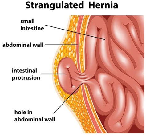 Get Specific With New Hernia Repair Codes CPT Changes