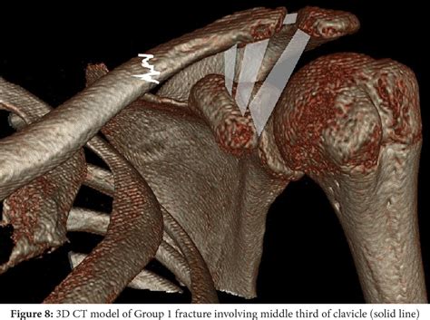 Figure 8 From Clavicle Fractures Allman And Neer Classification