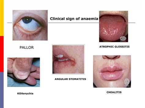 Anaemia In Pregnancy Ppt