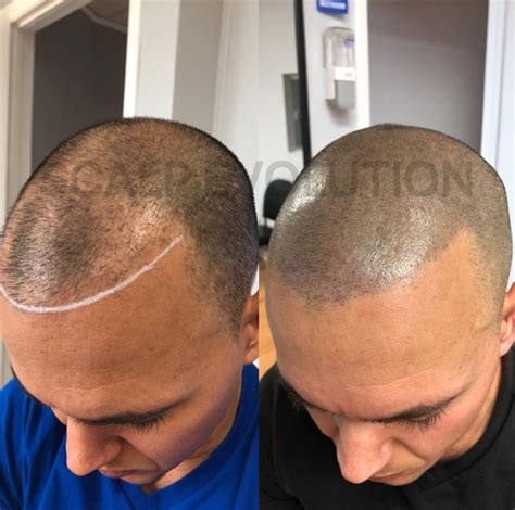 Can Scalp Micropigmentation Conceal Hair Transplant Scars Scalp Can Scalp Micropigmentation Conceal Hair Transplant Scars Scalp