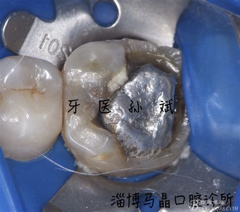 原创原银汞合金充填的隐裂患牙使用树脂材料直接充填 牙医孙斌的博客 KQ88口腔博客