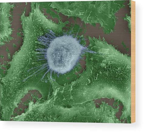 Lung Epithelial Cancer Cell Among Healthy Epithelia 2 Wood Print By