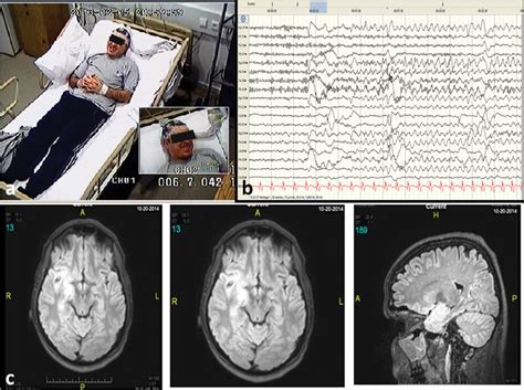 Patient 20 A Smile Awareness And Automatisms B Ictal Eeg F8 T4