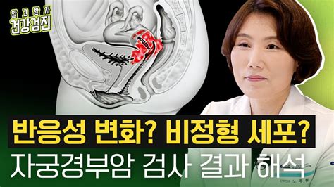 반응성세포변화는 정상인데 비정형 편평상피세포는 추가 검사 필요 Hpv는 치료 안 해도 없어지나요 자궁경부암 검사 결과지 해석법 일산차병원 산부인과 노주원 교수