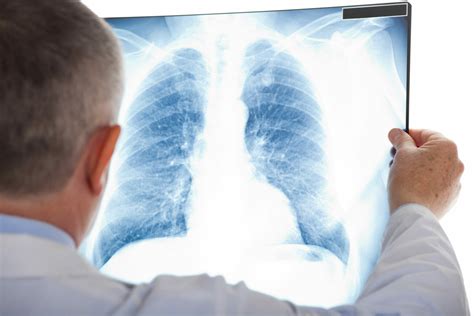 Lung Nodules Pulmonary Nodules