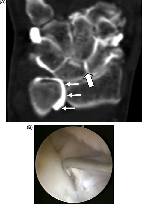 Figure 1 From Mdct Arthrography Of The Wrist Diagnostic Accuracy And