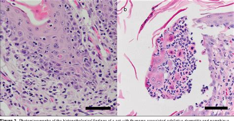 Figure 2 From Comorbidity Of Ectopic Thymoma Associated Exfoliative Dermatitis And Pemphigus