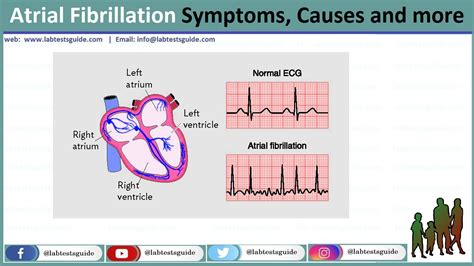 Atrial Fibrillation Symptoms Causes Prevention And More Lab Tests Guide