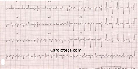 Curso Ecg Flúter Auricular Común En Paciente Que Toma Flecainida