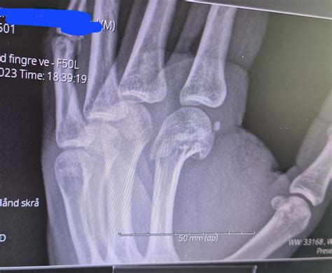 2nd Metacarpal Fracture R Radiology
