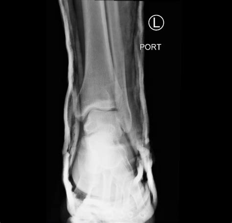Medial Subtalar Dislocation A Case Report JETem