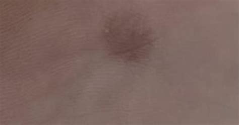 Hyperpigmentation On Sole Of Foot