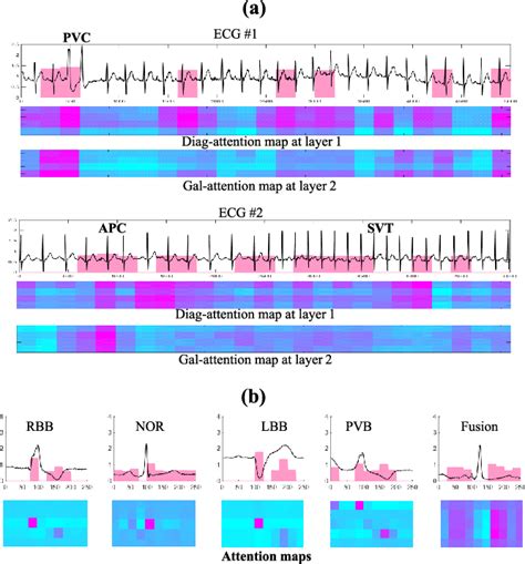 Figure 5 From Refined Self Attention Transformer Model For Ecg Based Arrhythmia Detection
