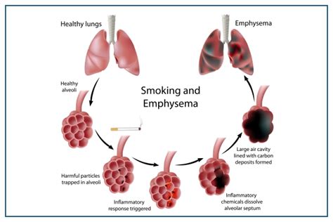 Emphysema Causes Symptoms Diagnosis Treatment 44 Off