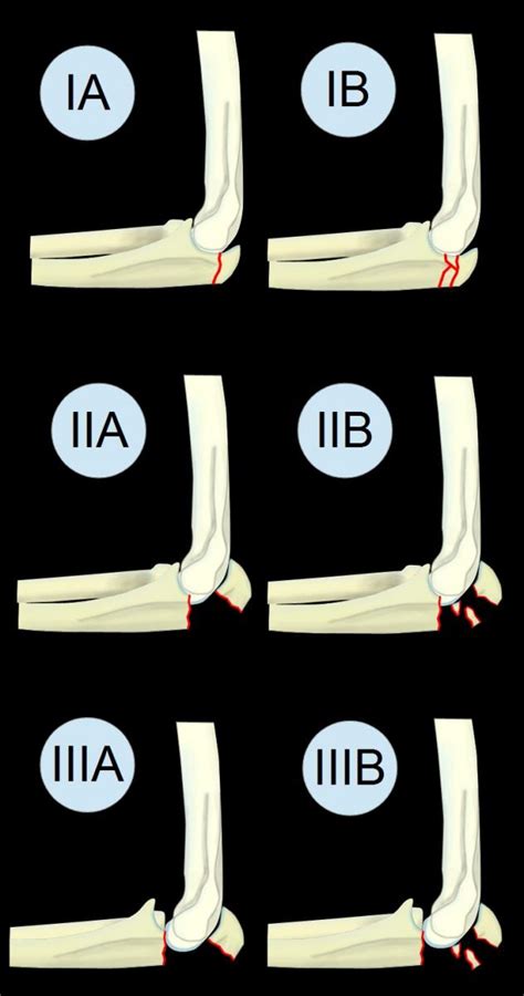 Fracture Of Olecranon Mayo Classification Classifications Online