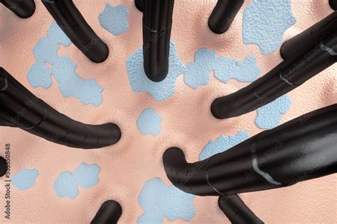 Fungal Disease Of The Skin Dandruff On The Scalp An Enlarged Image Of The Hair And Scalp