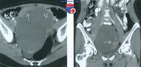 КТ МРТ УЗИ при светлоклеточном раке яичника