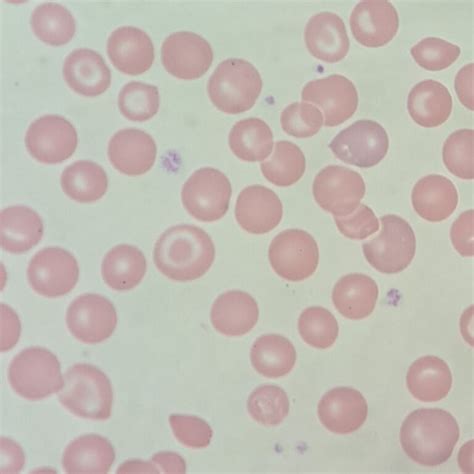 Target Cells Appearance And Clinical Significance Medlabbuddy