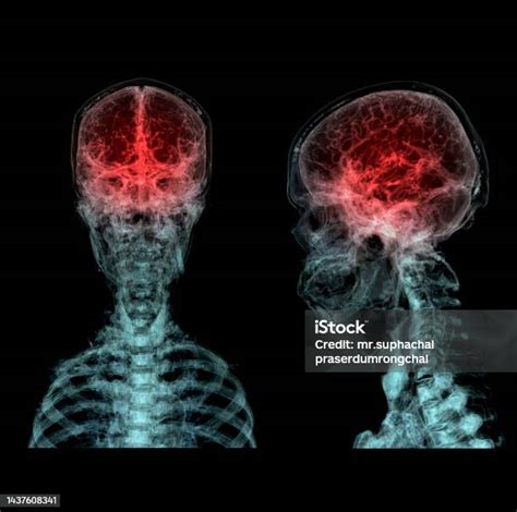 머리의 대뇌 동맥에 대한 의학적으로 정확한 그림을 3d 렌더링 의료용 스캔에 대한 스톡 사진 및 기타 이미지 의료용 스캔