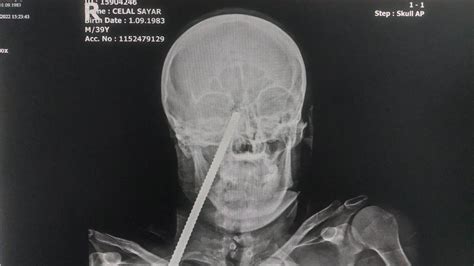 Turkish Worker Celal Sayar Survives After Face Impaled By Steel Bar
