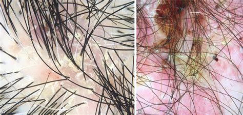 Most Significant Trichoscopic Features In Our Patients With Autoimmune Download Scientific