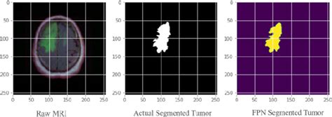 figure 1 from design and comparison of tumor segmentation using an ml based clustering method