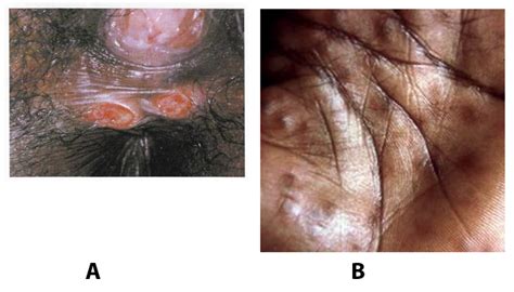 Aphthous Ulcers Genital