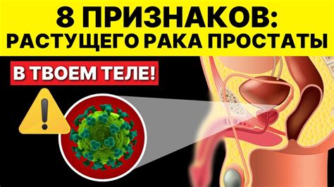 8 Ранних Признаков Рака Простаты Которые Нельзя Игнорировать Youtube