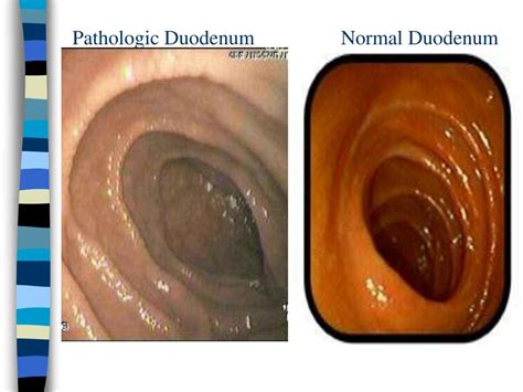 Ppt Celiac Disease By Emer Byrne Powerpoint Presentation Free
